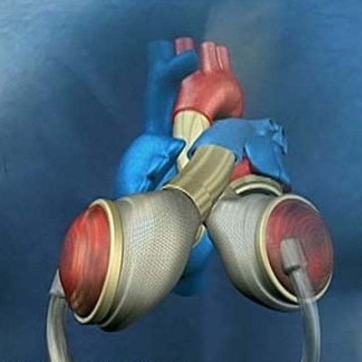 Colombia hace el primer implante de "corazón artificial" en Suramérica ...